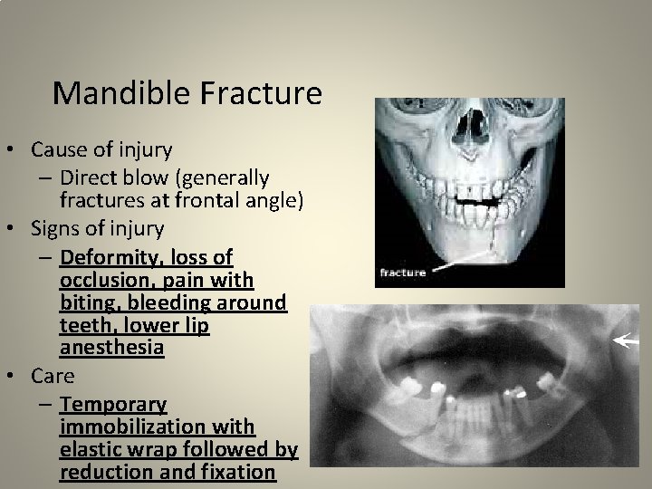 Facial Injuries Sports Med II Mandible Fracture Cause