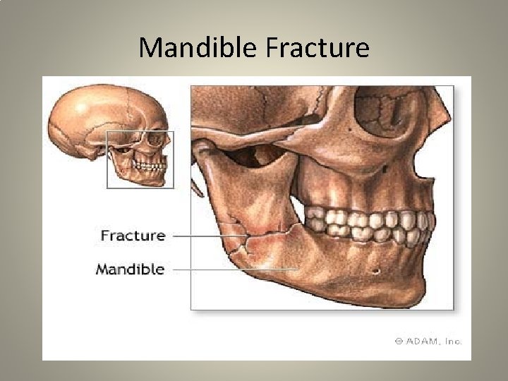 Facial Injuries Sports Med II Mandible Fracture Cause