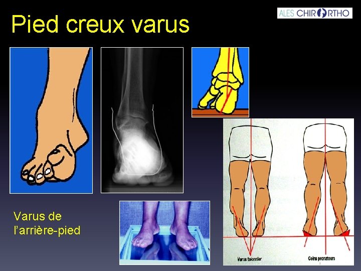 Le pied tour dhorizon rapide Examen pied plat