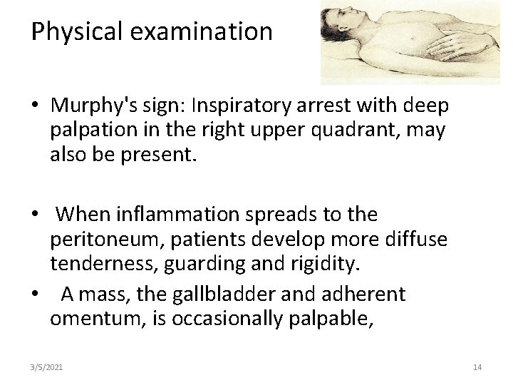Gall stone Cholelithiasis and CBD stone Choledocholithiasis Dr