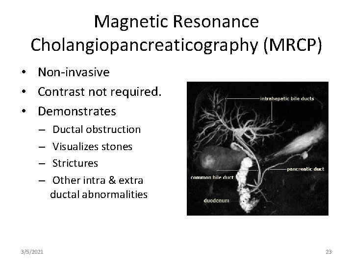 Gall stone Cholelithiasis and CBD stone Choledocholithiasis Dr