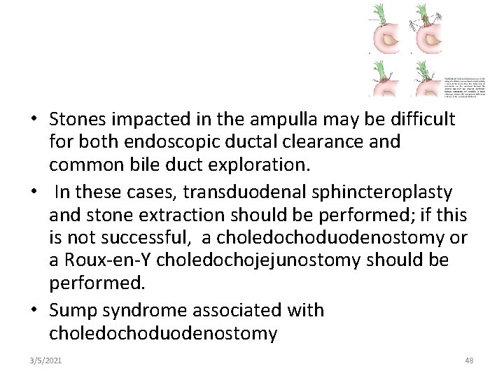Gall stone Cholelithiasis and CBD stone Choledocholithiasis Dr
