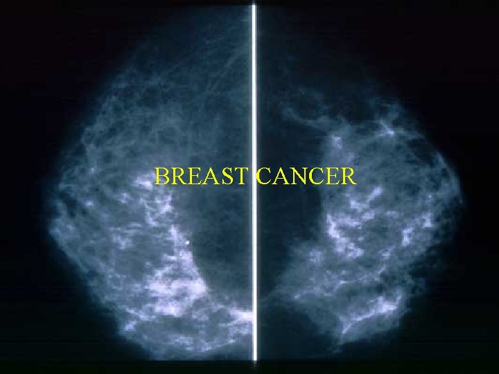 BREAST CANCER 1 Breast Cancer Breast cancer occurs