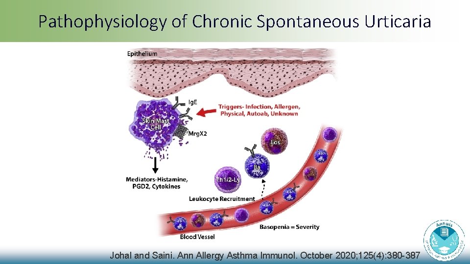 Current and Emerging Treatments for Chronic Spontaneous Urticaria