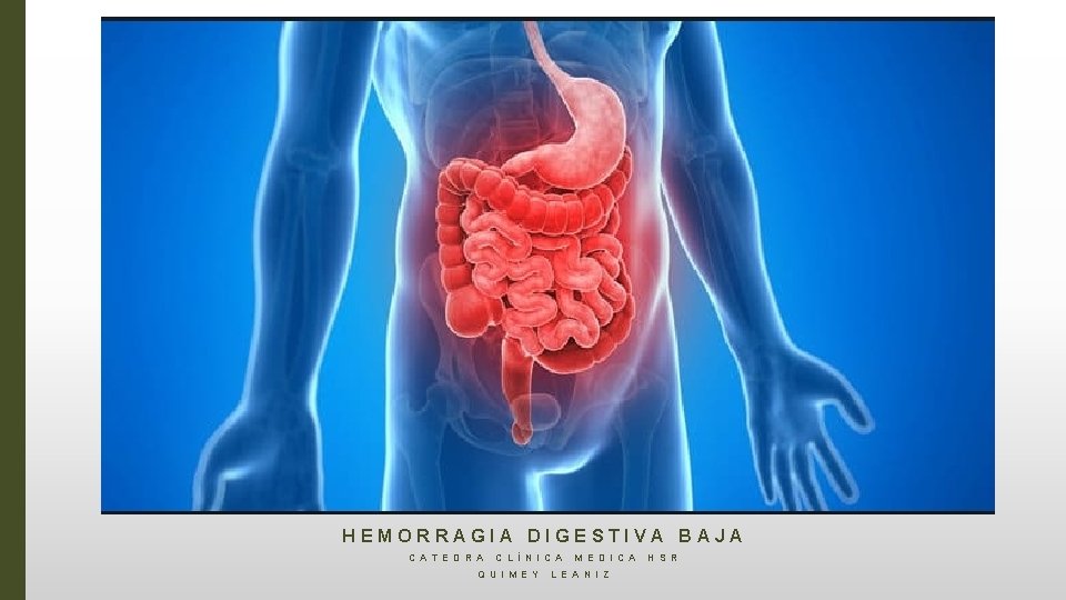 HEMORRAGIA DIGESTIVA BAJA C A T E D
