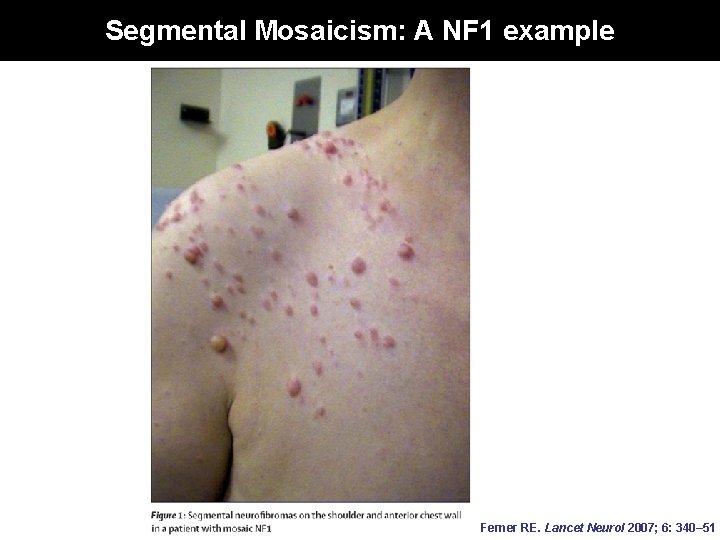 Taller 7 Sndrome Hereditarios con Afectacin Cutnea Neurofibromatosis