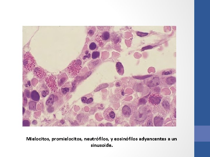 Interpretacin de la biopsia de Mdula sea Luis