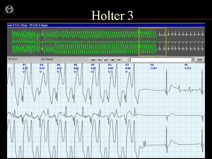 CENTRO MODELO DE CARDIOLOGA Servicio de Arritmias Caso