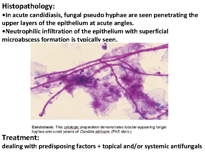 Treatment Longterm highdose penicillin or penicillin analogs are