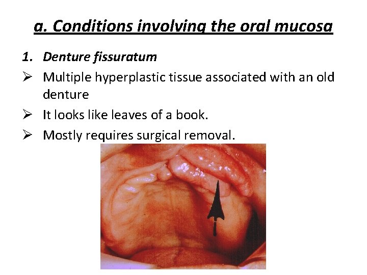 PRE PROSTHETIC PREPARATION OF THE DENTURE FOUNDATION METHODS