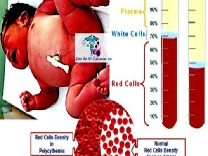 Lecture 4 Polycythemia causes clinical signs and labortary