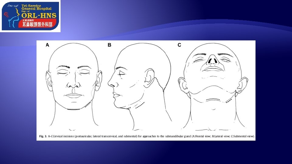 TRANSORAL EXCISION OF SUBMANDIBULAR GLAND JIHCHIN LEE MD