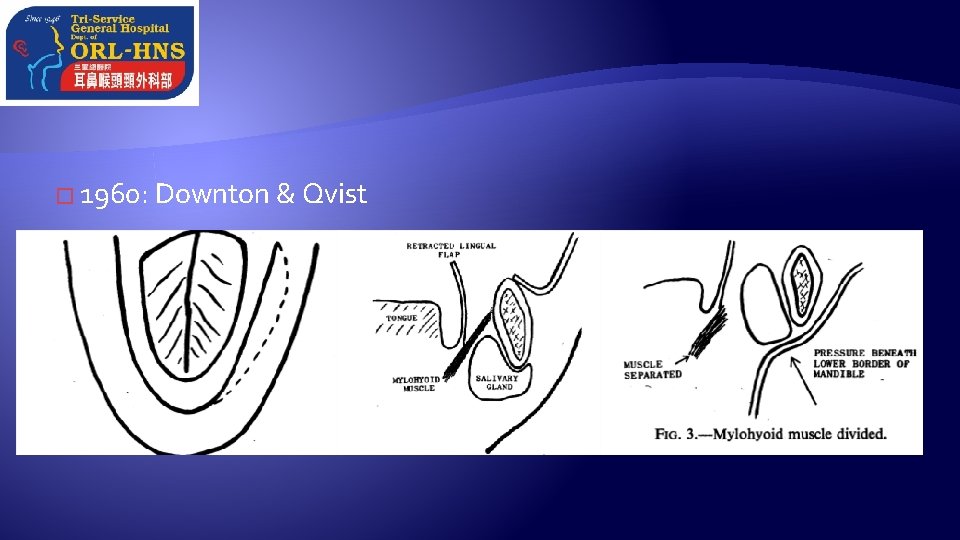 TRANSORAL EXCISION OF SUBMANDIBULAR GLAND JIHCHIN LEE MD