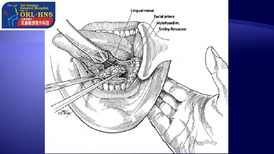 TRANSORAL EXCISION OF SUBMANDIBULAR GLAND JIHCHIN LEE MD