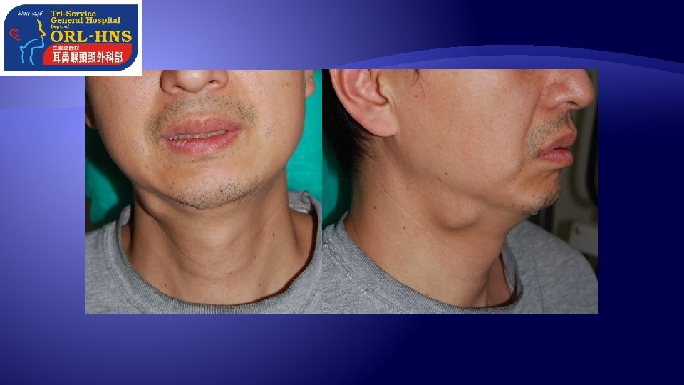 TRANSORAL EXCISION OF SUBMANDIBULAR GLAND JIHCHIN LEE MD