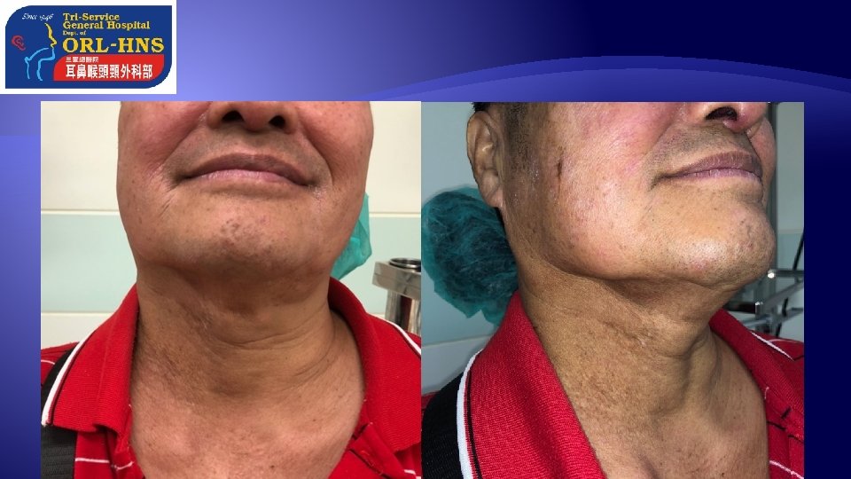 TRANSORAL EXCISION OF SUBMANDIBULAR GLAND JIHCHIN LEE MD