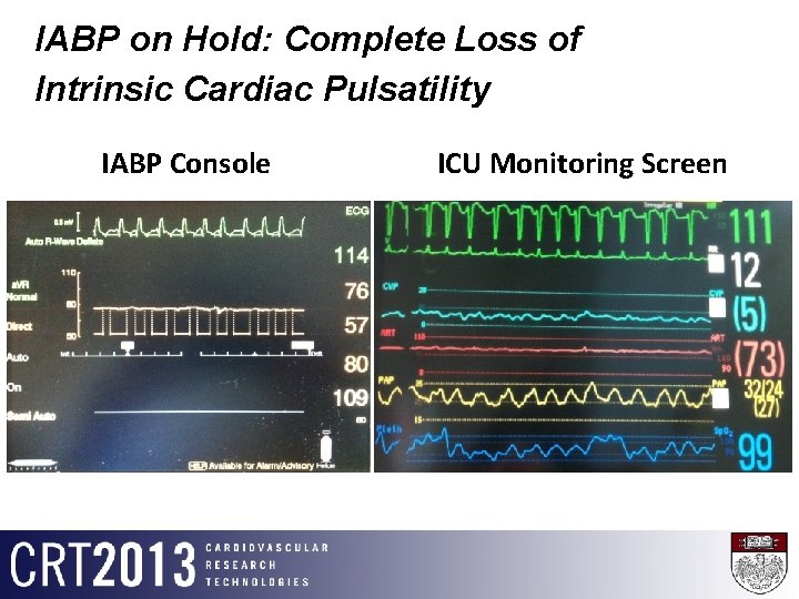 Subclavian IntraAortic Balloon Pump Followed by Peripheral VenoArterial