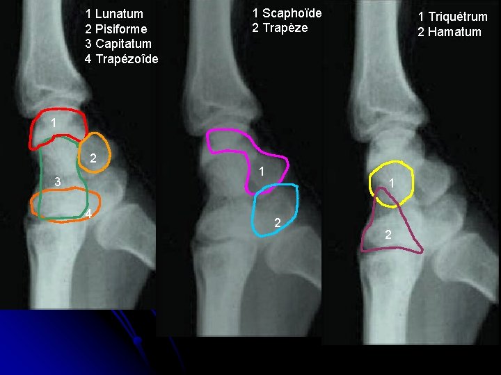 ANATOMIE RADIOLOGIQUE DU POIGNET RADIOLOGIE CONVENTIONNELLE 1 Incidence