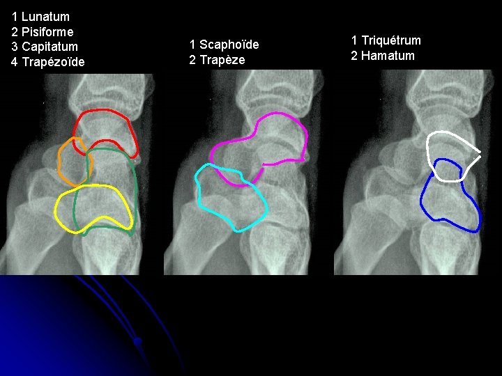 ANATOMIE RADIOLOGIQUE DU POIGNET RADIOLOGIE CONVENTIONNELLE 1 Incidence