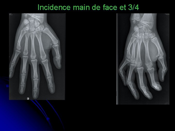 ANATOMIE RADIOLOGIQUE DU POIGNET RADIOLOGIE CONVENTIONNELLE 1 Incidence