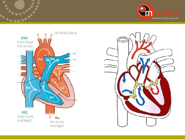 Diagnosis and treatment RHD Bo Remenyi Paediatric Cardiologist