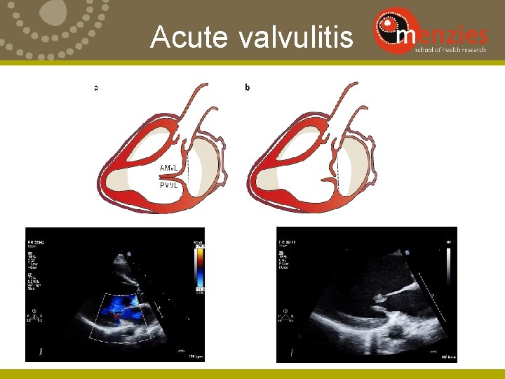 Diagnosis and treatment RHD Bo Remenyi Paediatric Cardiologist