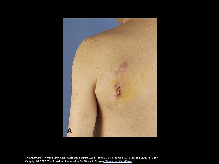 The extended pectoralis major flap for reconstruction of