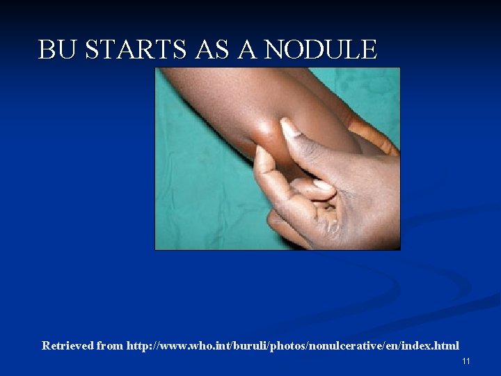 Buruli Ulcers A neglected tropical disease By Geraldine