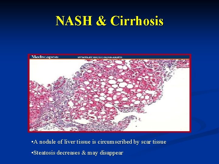 Nonalcoholic Fatty Liver Disease NAFLD Masi Khaja M