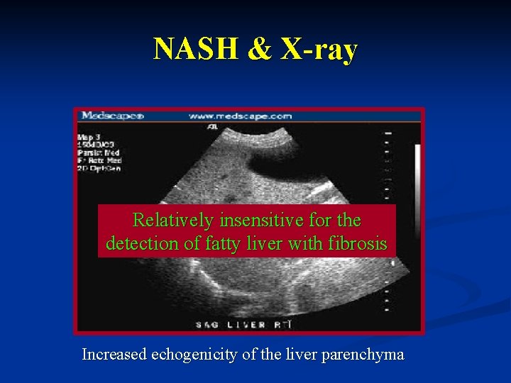 Nonalcoholic Fatty Liver Disease NAFLD Masi Khaja M