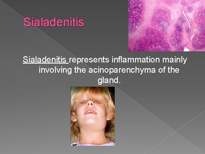 Parotid region It is a fascial lined space