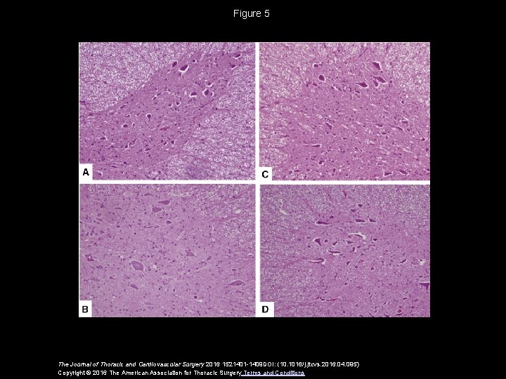 Oxygenation of the cerebrospinal fluid with artificial cerebrospinal