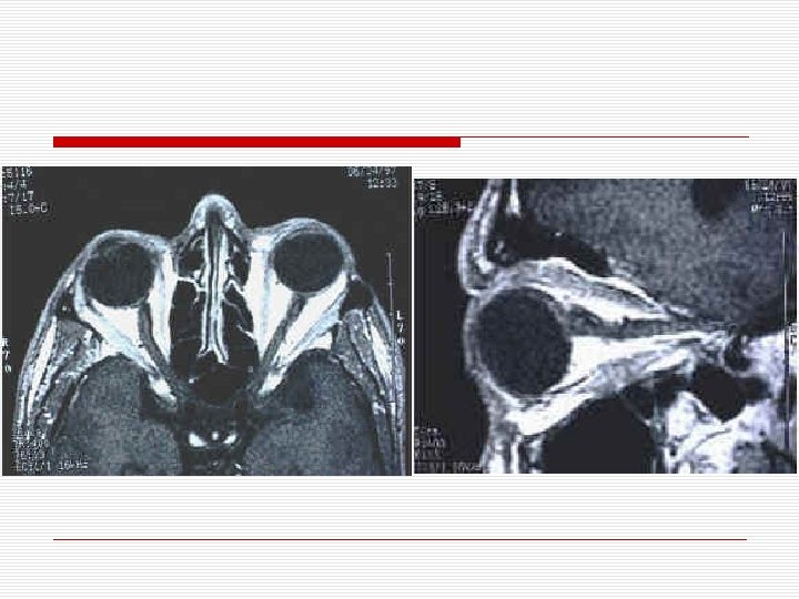 MRI 3 MRI o Magnetic resonance imaging MRI