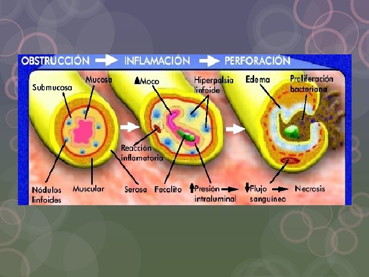 APENDICITIS AGUDA 1534 Andreas Vesalius Primera descripcin del