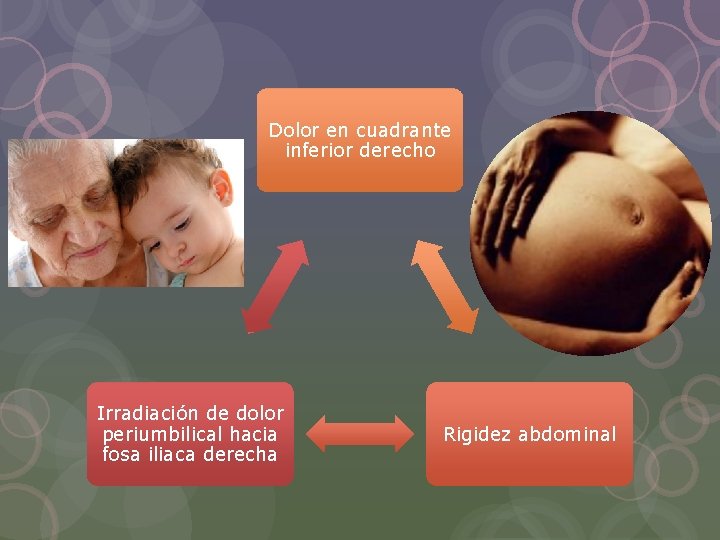 APENDICITIS AGUDA 1534 Andreas Vesalius Primera descripcin del