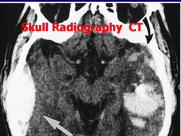 Evaluation management of head injured patient Classification of