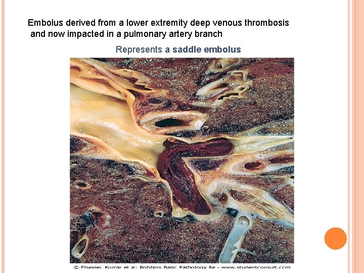 EMBOLISM An embolus is a detached intravascular solid