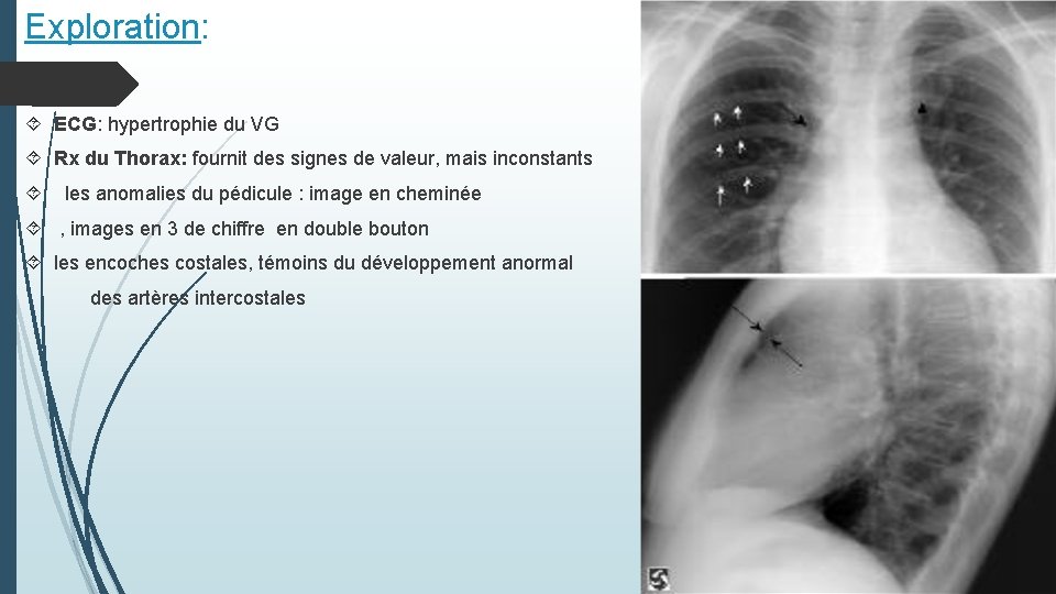 Coarctation de laorte Introduction La coarctation aortique est