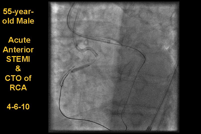 ASAHI CORSAIR MICROCATHETER The Device that Revolutionized CTO