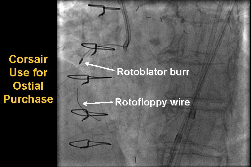 ASAHI CORSAIR MICROCATHETER The Device that Revolutionized CTO