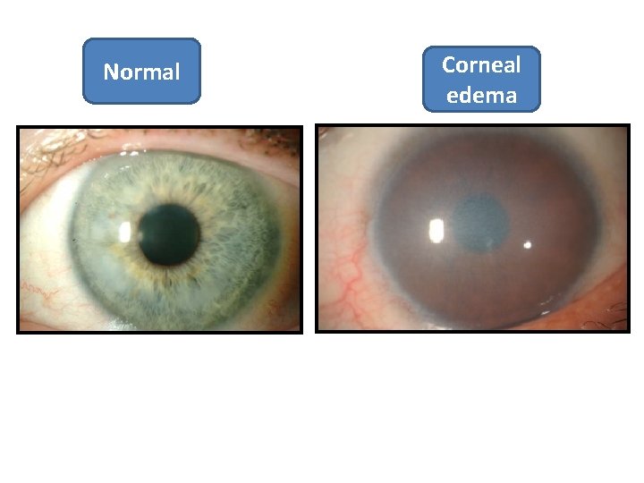 Cornea Dr Soujanya K MBBS MS DNB FPRS