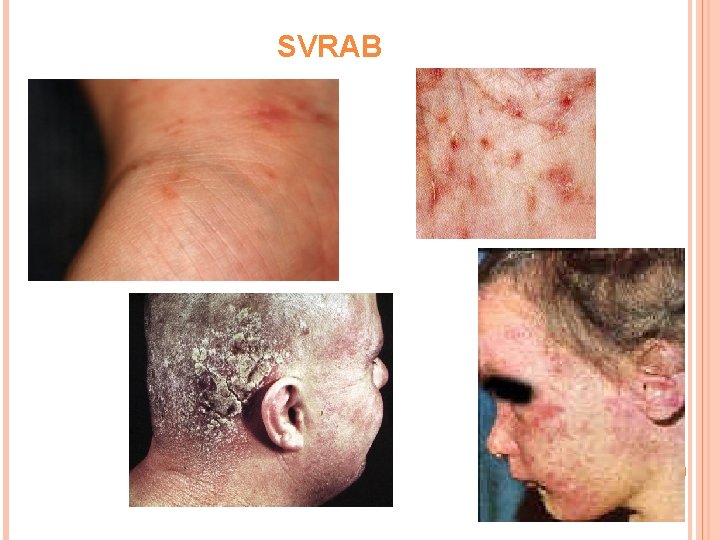 POHLAVN NEMOCI Pavla Strkov Lenka vecov KAPAVKA Penos