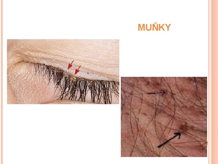 POHLAVN NEMOCI Pavla Strkov Lenka vecov KAPAVKA Penos