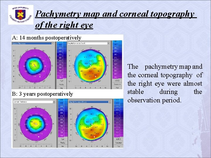 ThreeYear Followup after LASIK in Eye with Extremely