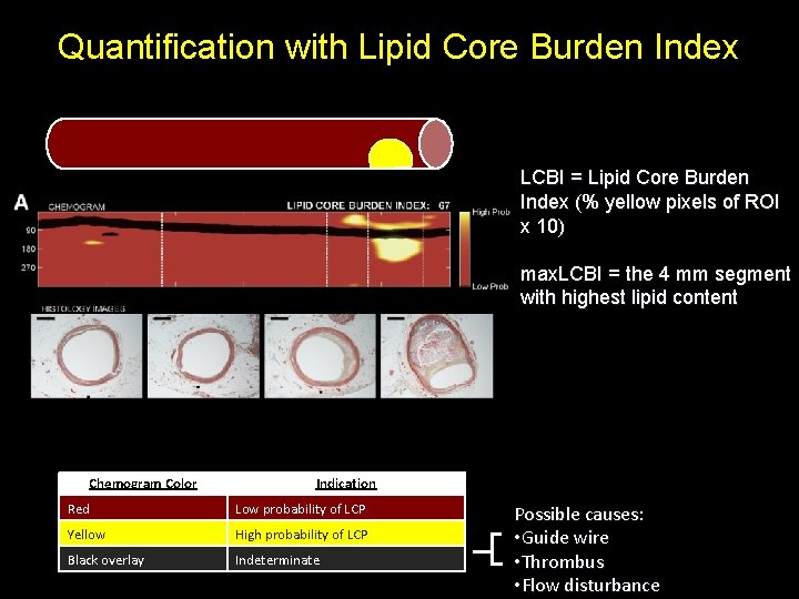 Can NIRS Detect Vulnerable Plaque The Rotterdam Experience