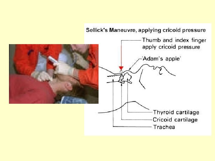 Making The Case for Cricoid Pressure D John