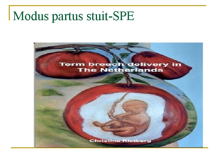 Modus partus bij stuitligging Vaginaal of Sectio Caesarea