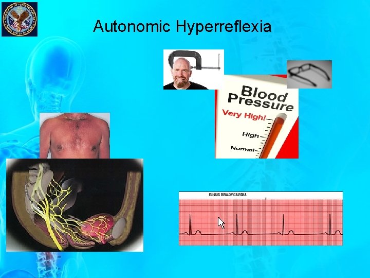 Anesthesia for Autonomic Hyperreflexia Case Presentation Review Mark