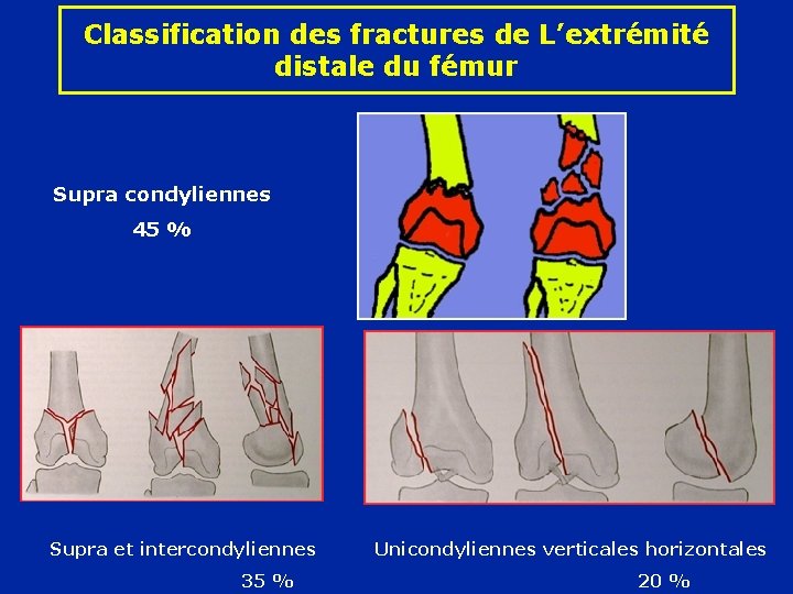 Les traumatismes osseux du genou DR BELAID SERVICE