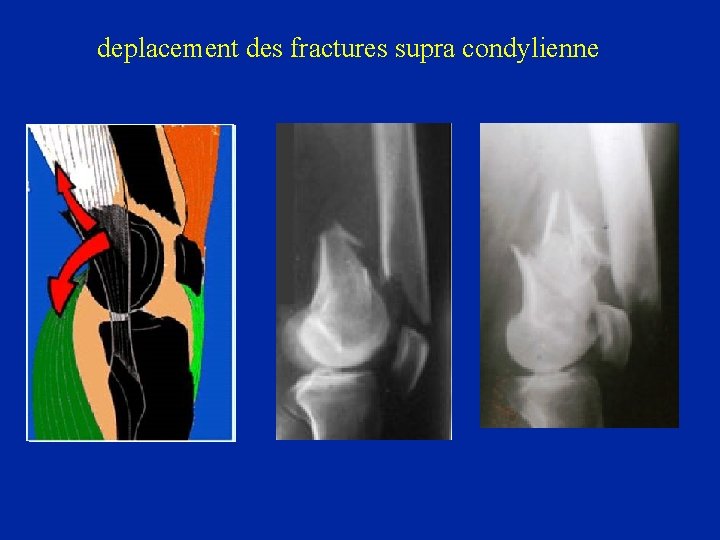 Les traumatismes osseux du genou DR BELAID SERVICE